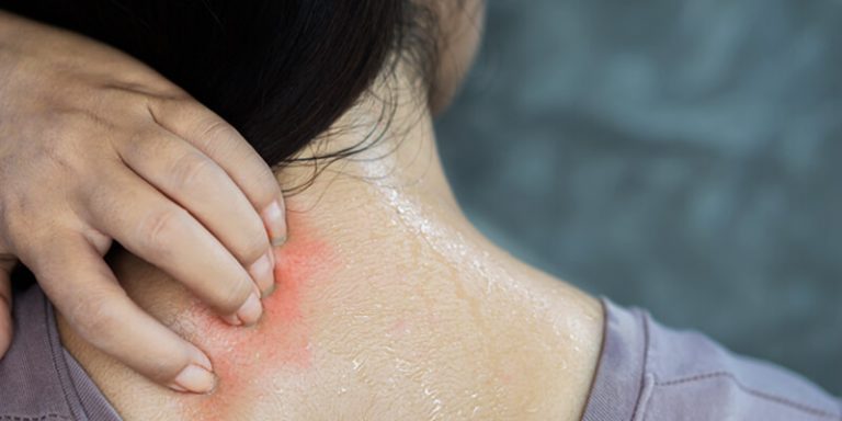 Top 3 Effective Tips to Protect Skin from Hard Water